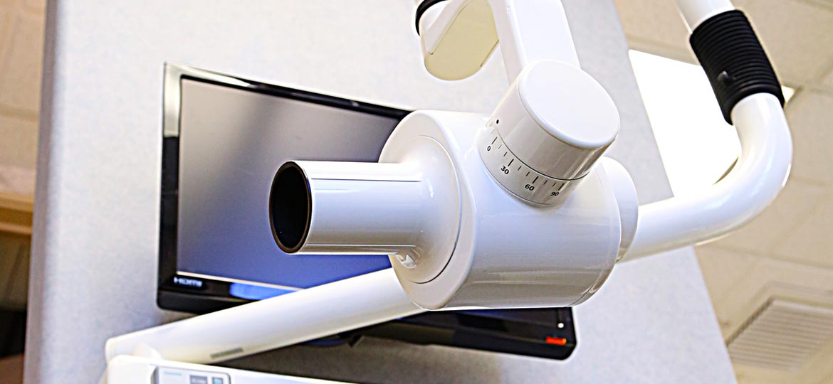 Post and Core Build–Up San Mateo & Daly City - Root Canals